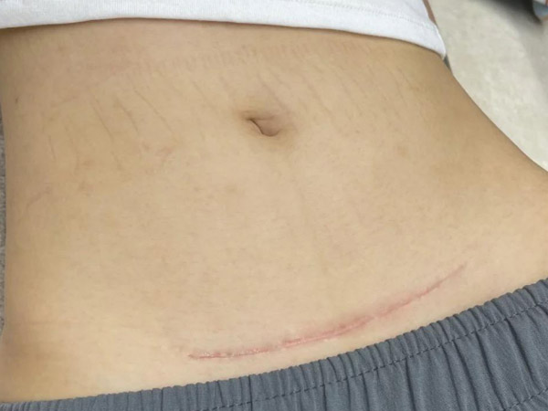 Linear Hypertrophic Scar After C Section Surgery Henan Biocontec
