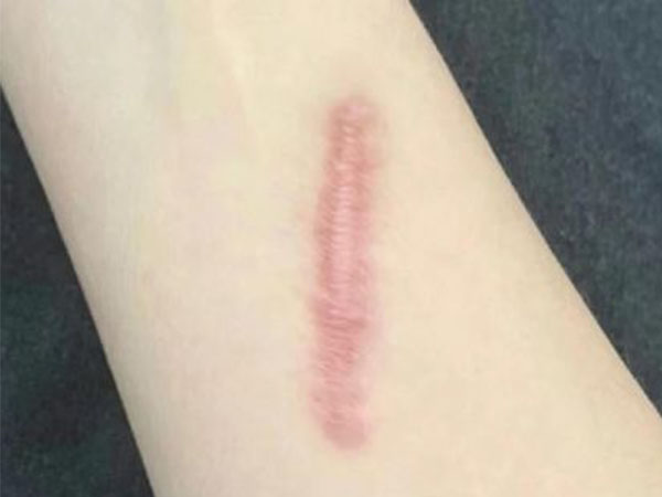 hypertrophy scar after trauma - Henan Biocontec Medical Co.,Ltd
