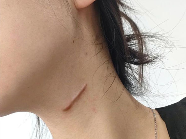 hypertrophy scar after trauma - Henan Biocontec Medical Co.,Ltd